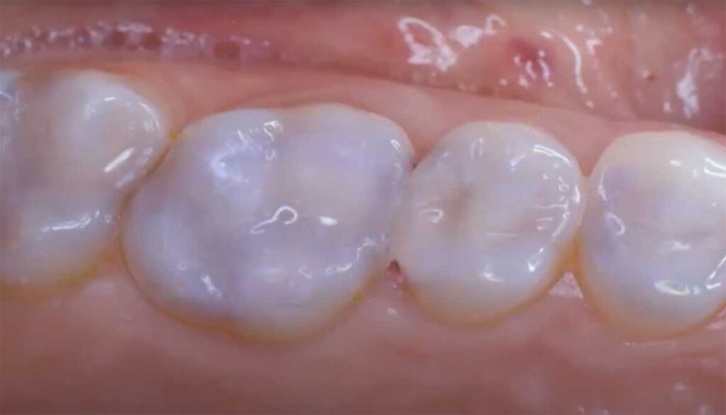 Tooth Colored Fillings - Branson Family Dentistry